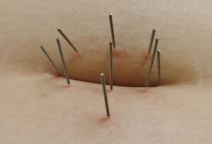 Post-Acupuncture Symptoms: Normal Reactions vs When to Worry ...